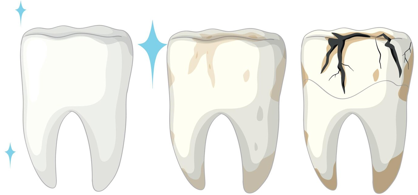 Broken Tooth Repair Dentist in Houston | URBN Dental